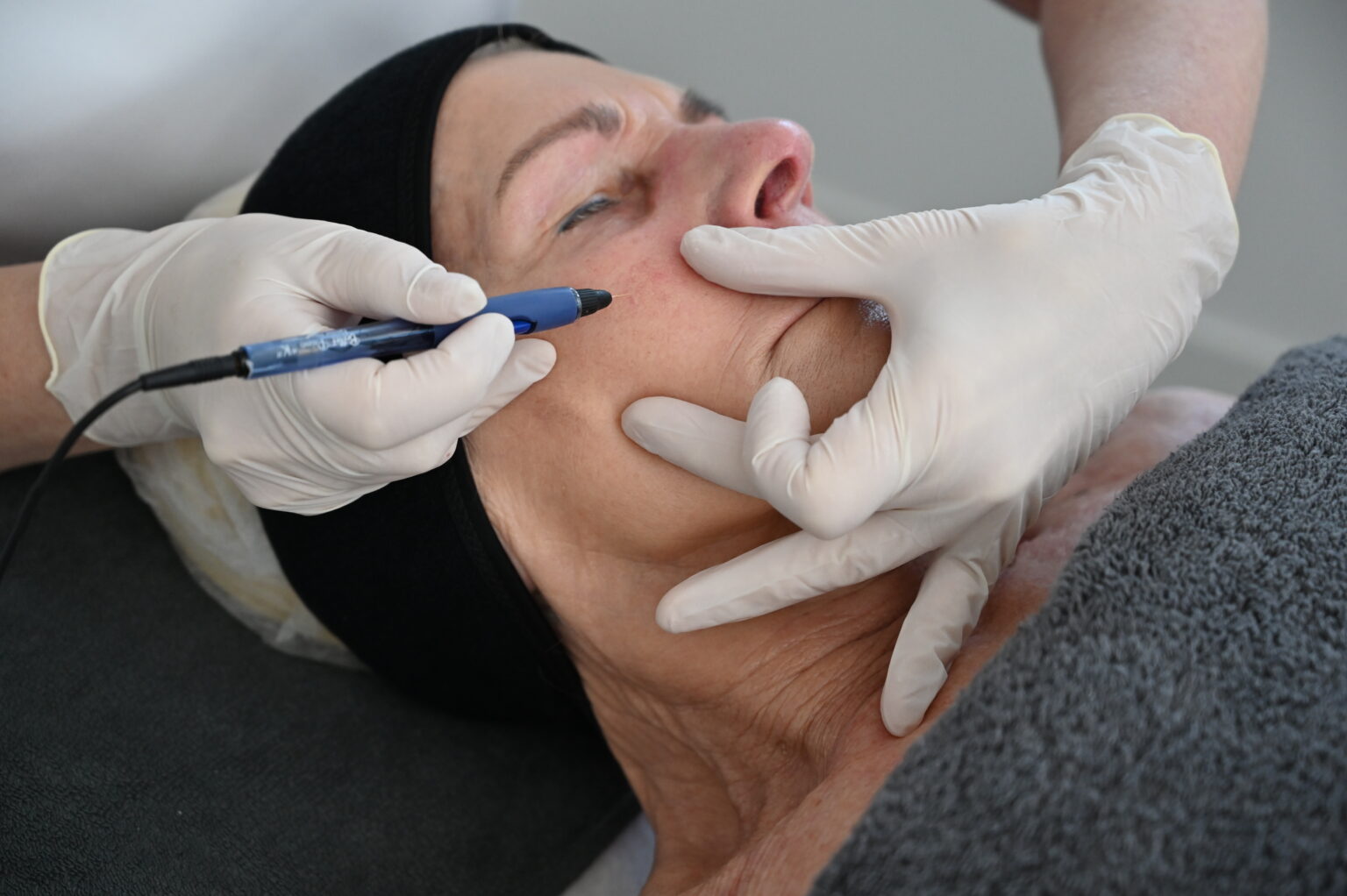 Couperose behandeling – Coagulatie – Fibromen / Steelwratjes - Beauty ...